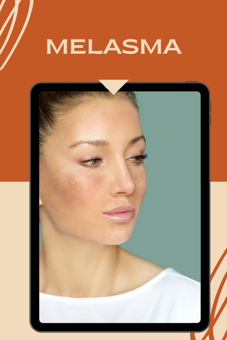 Skin Blemishes: Types And Ways To Remove Skin Blemishes Naturally