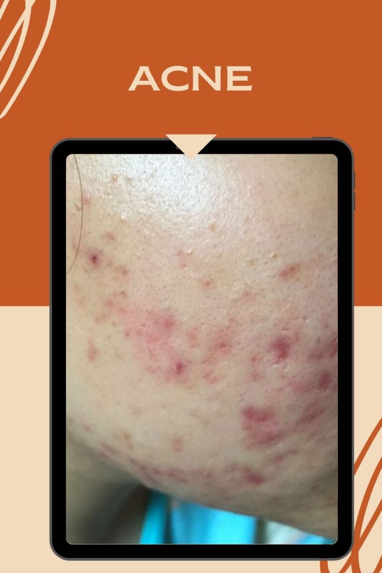 Skin Blemishes: Types And Ways To Remove Skin Blemishes Naturally