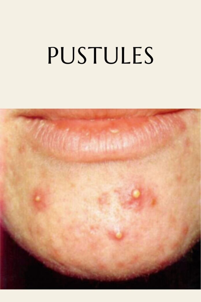 Tips On How To Remove Pimples Naturally