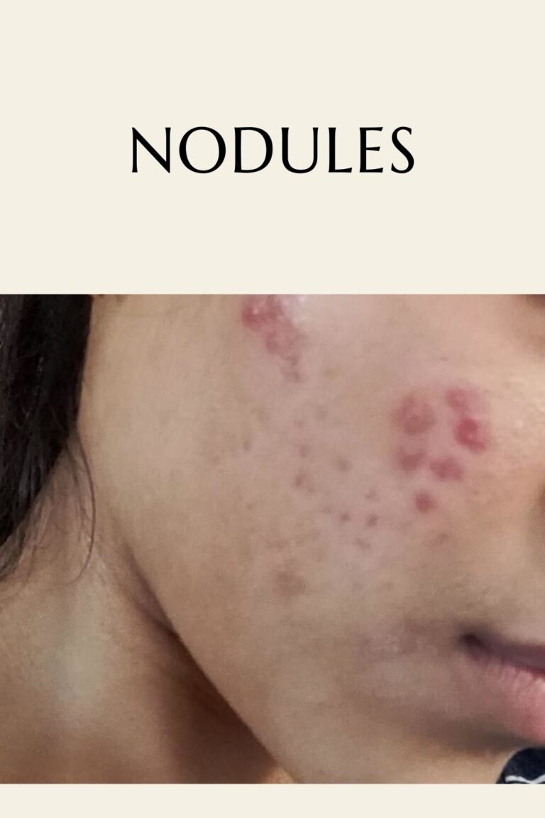 Tips On How To Remove Pimples Naturally